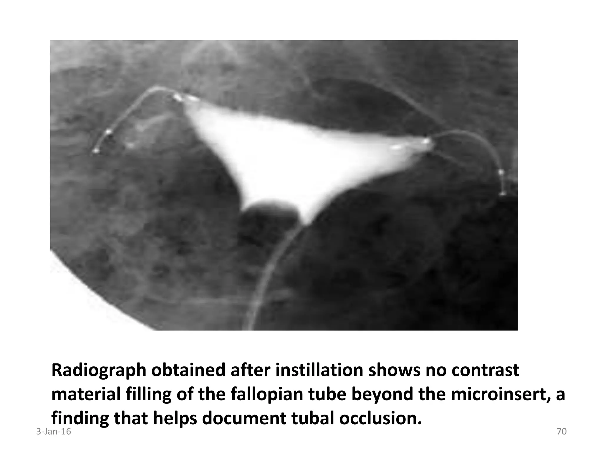 Hysterosalpingography | PPTX