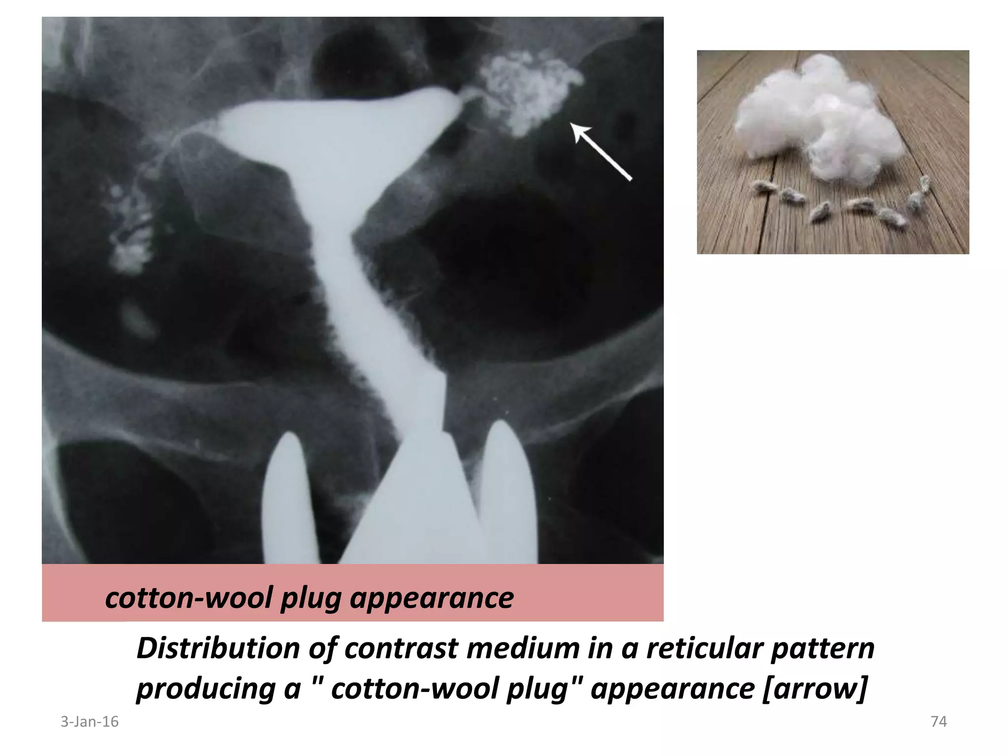Hysterosalpingography | PPTX