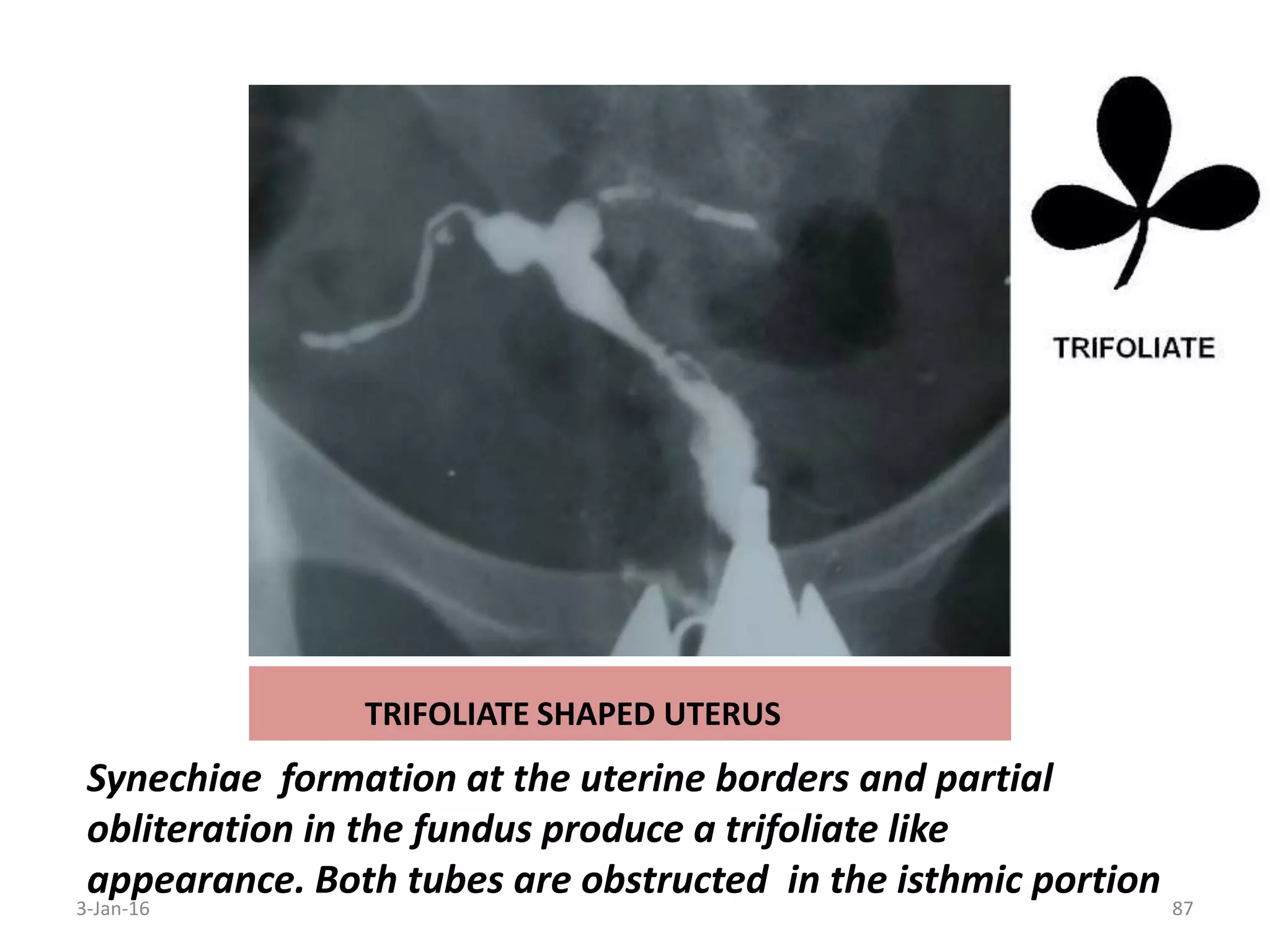 Hysterosalpingography | PPTX