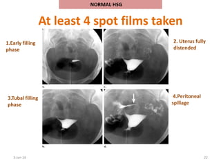 Hysterosalpingography | PPTX