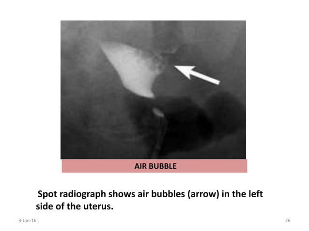 Hysterosalpingography | PPTX