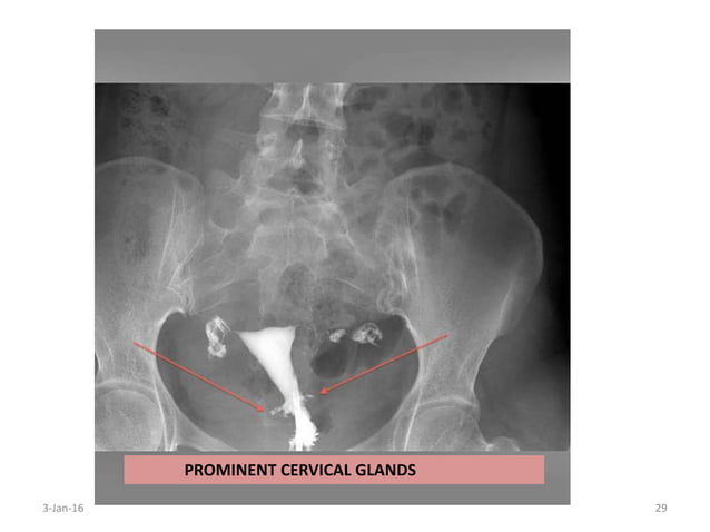 Hysterosalpingography | PPTX