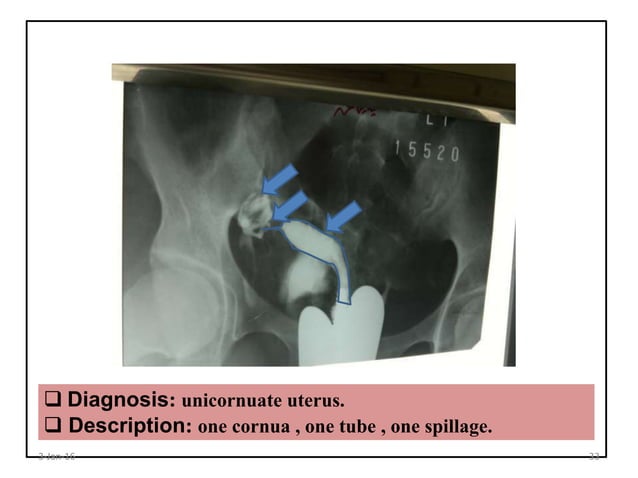 Hysterosalpingography | PPTX