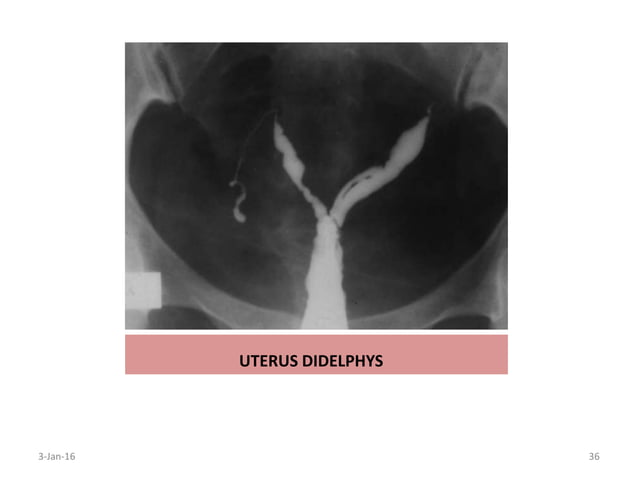 Hysterosalpingography | PPTX