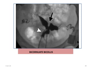 Hysterosalpingography | PPTX