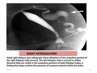 Hysterosalpingography | PPTX