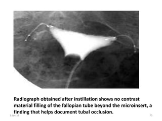 Hysterosalpingography | PPTX