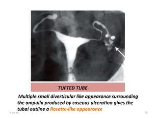 Hysterosalpingography | PPTX