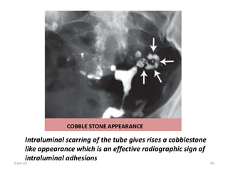 Hysterosalpingography | PPTX