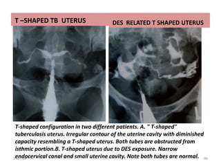 Hysterosalpingography | PPTX