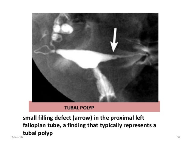 Hysterosalpingography
