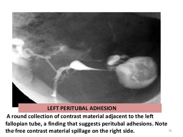 Hysterosalpingography