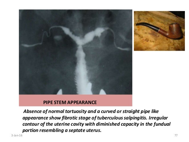 Hysterosalpingography
