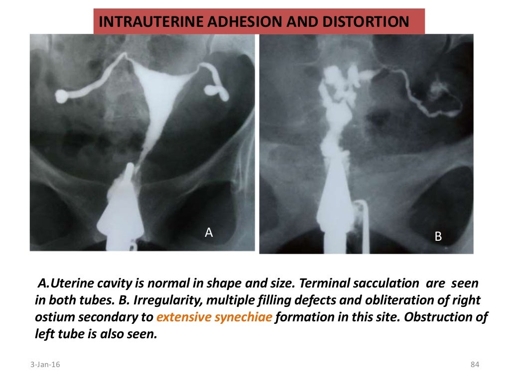 Hysterosalpingography