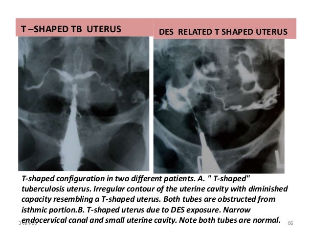 Hysterosalpingography
