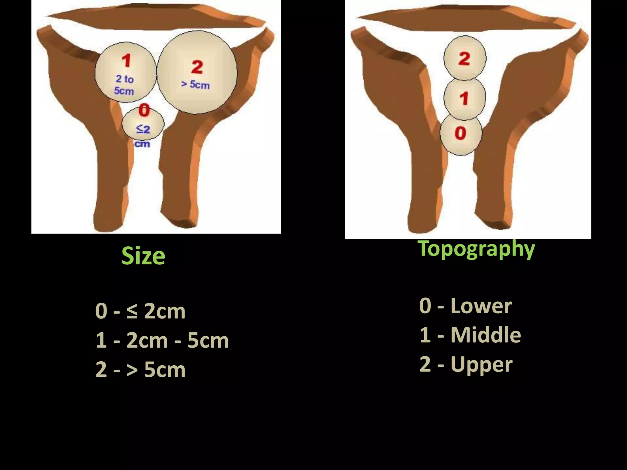 Hysteroscopic classification of submucous fibroids | PPTX