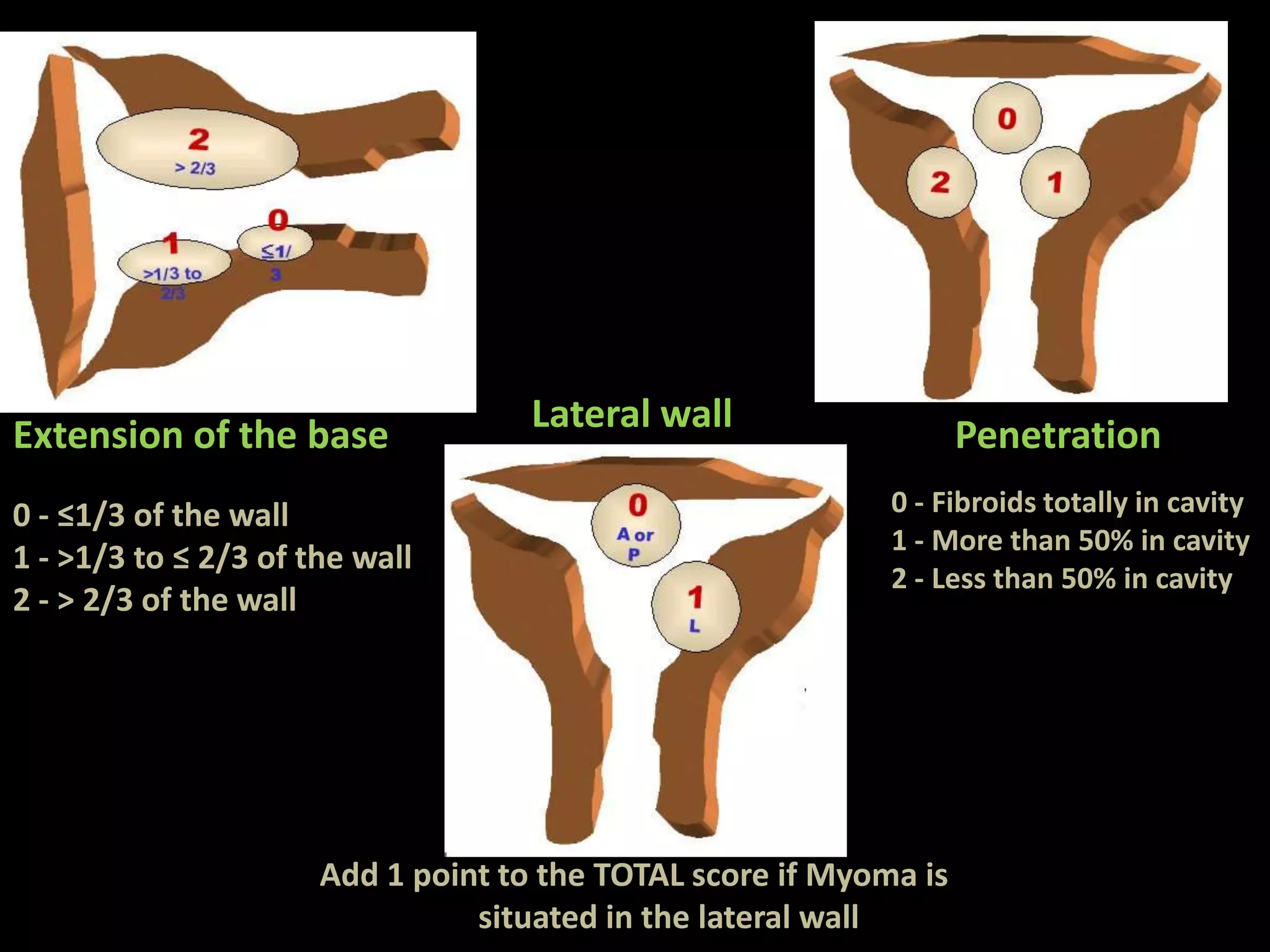 Hysteroscopic classification of submucous fibroids | PPTX