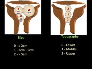 Hysteroscopic classification of submucous fibroids | PPTX