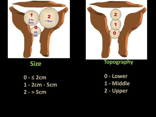 Hysteroscopic classification of submucous fibroids | PPTX ...