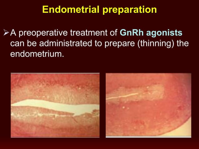 Hysteroscopic endometial resection | PDF | Pregnancy | Reproductive Health