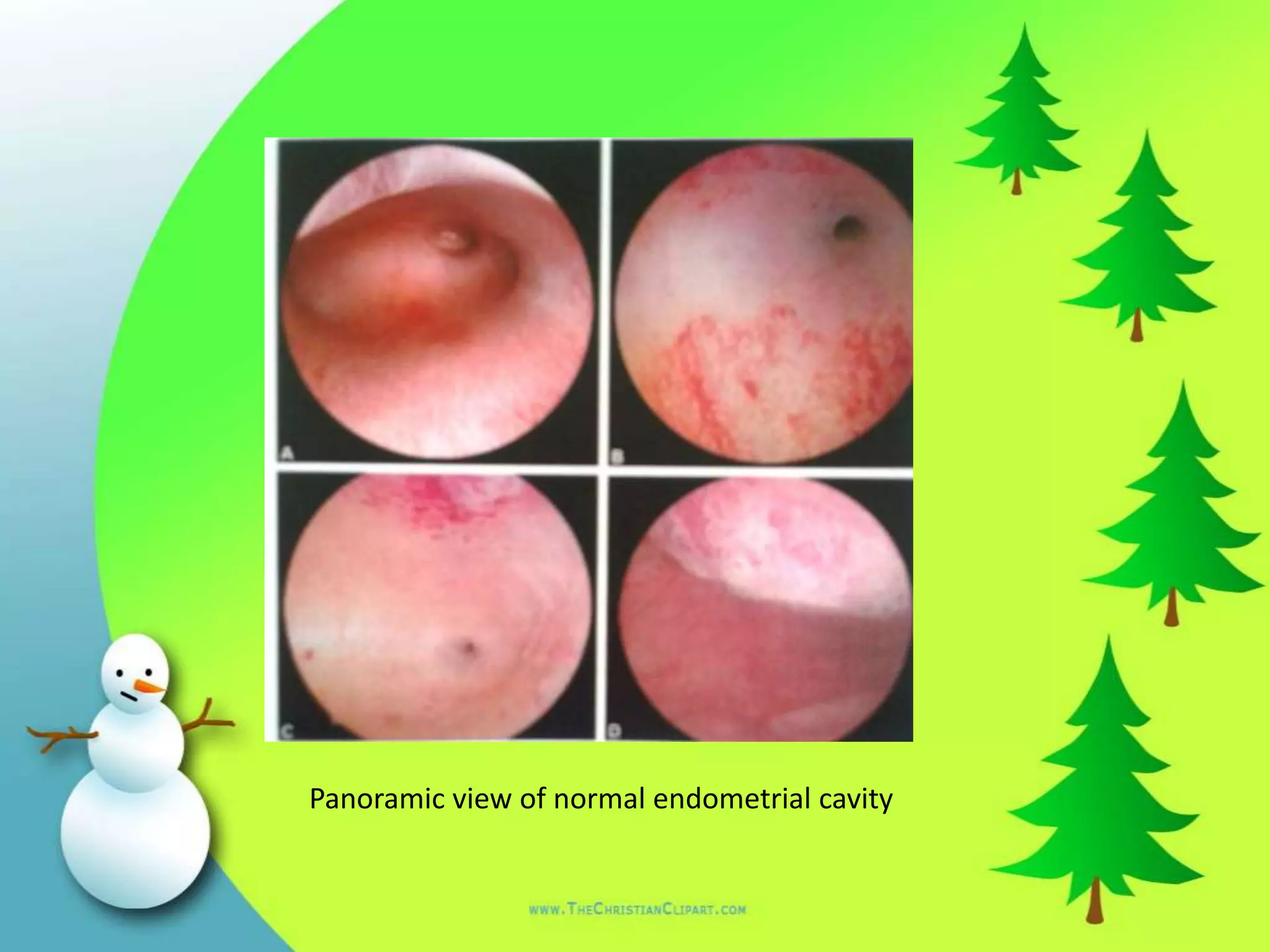 Hysteroscopy | PPTX