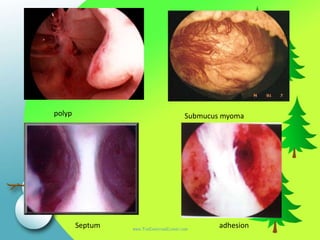 Hysteroscopy | PPTX