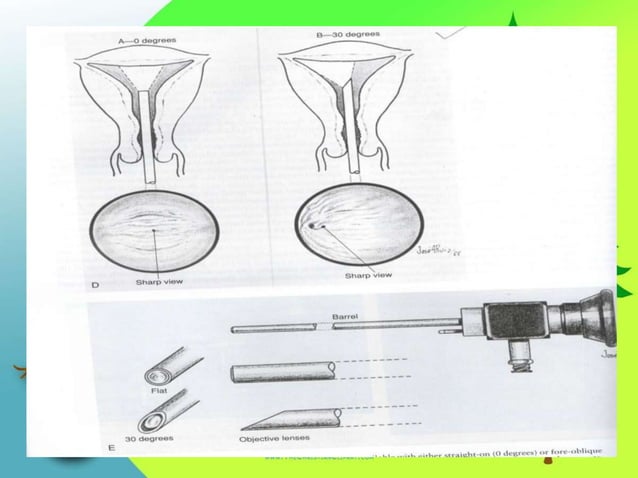 Hysteroscopy | PPTX | Reproductive Health | Diseases and Conditions