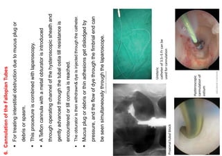Hysteroscopy indication | PDF