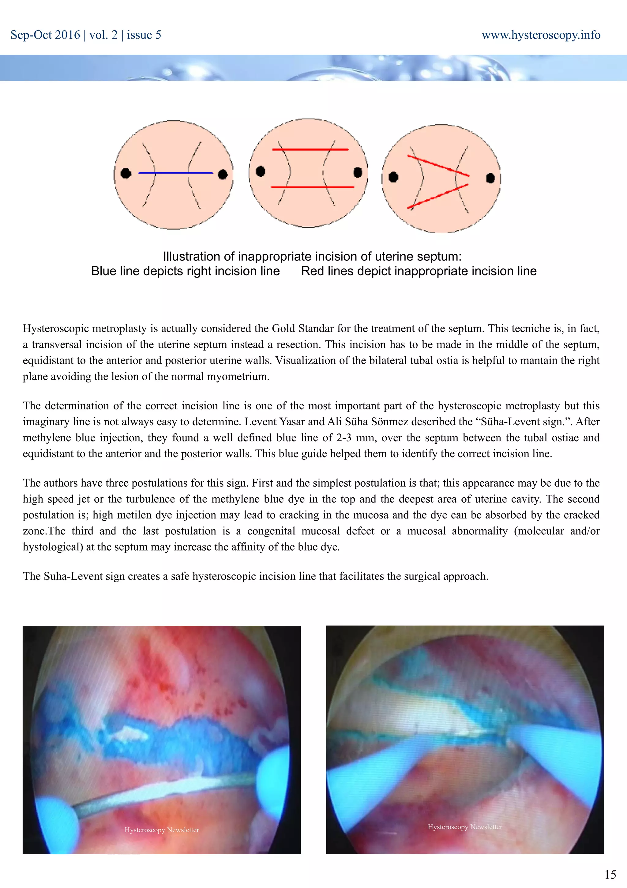 Hysteroscopy newsletter vol 2 issue 5 english | PDF