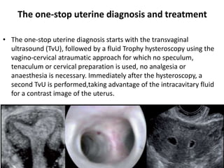 Hysteroscopy pre IVF is it neccessary ?? | PPT