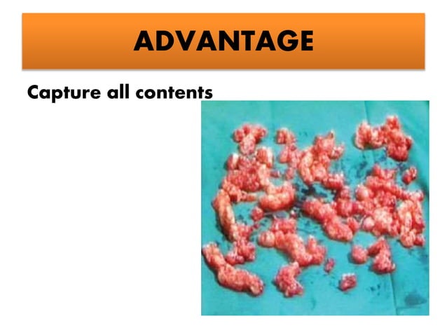 Hystroscopic morcellation..waled ayad | PPT