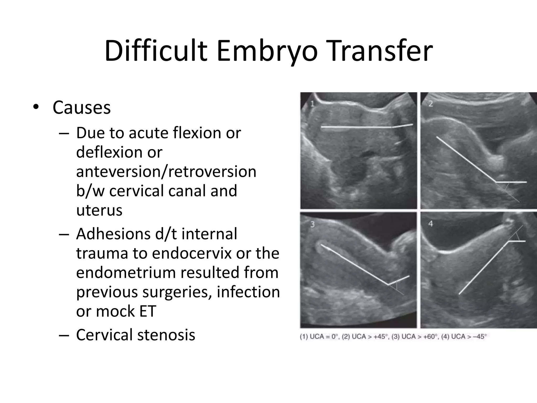 Role of Hysteroscopy in Difficult Embryo Transfers | PPTX