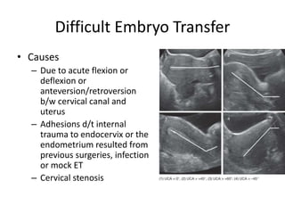 Role of Hysteroscopy in Difficult Embryo Transfers | PPT