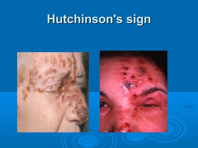 Herpes zoster ophthalmicus | PPT | Skin and Dermatology | Diseases and ...