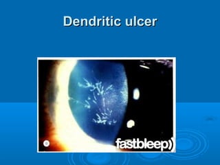 Herpes zoster ophthalmicus | PPT