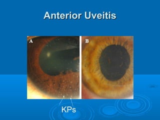 Herpes zoster ophthalmicus | PPT