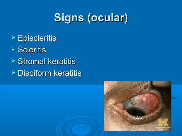 Herpes zoster ophthalmicus | PPT | Skin and Dermatology | Diseases and ...