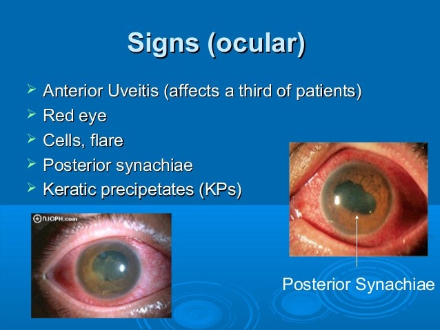 Herpes zoster ophthalmicus