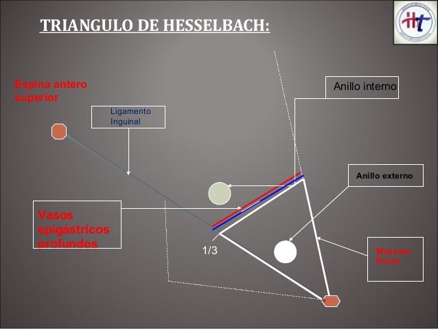 I hernia inguinal htca 2016 (2)