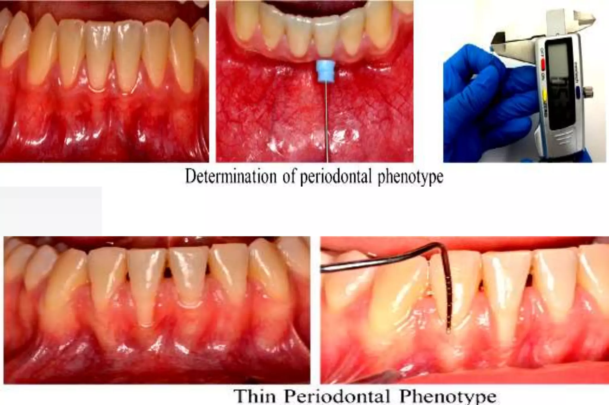 i-prf &MN in gingival augmentation in thin phenotype | PPTX
