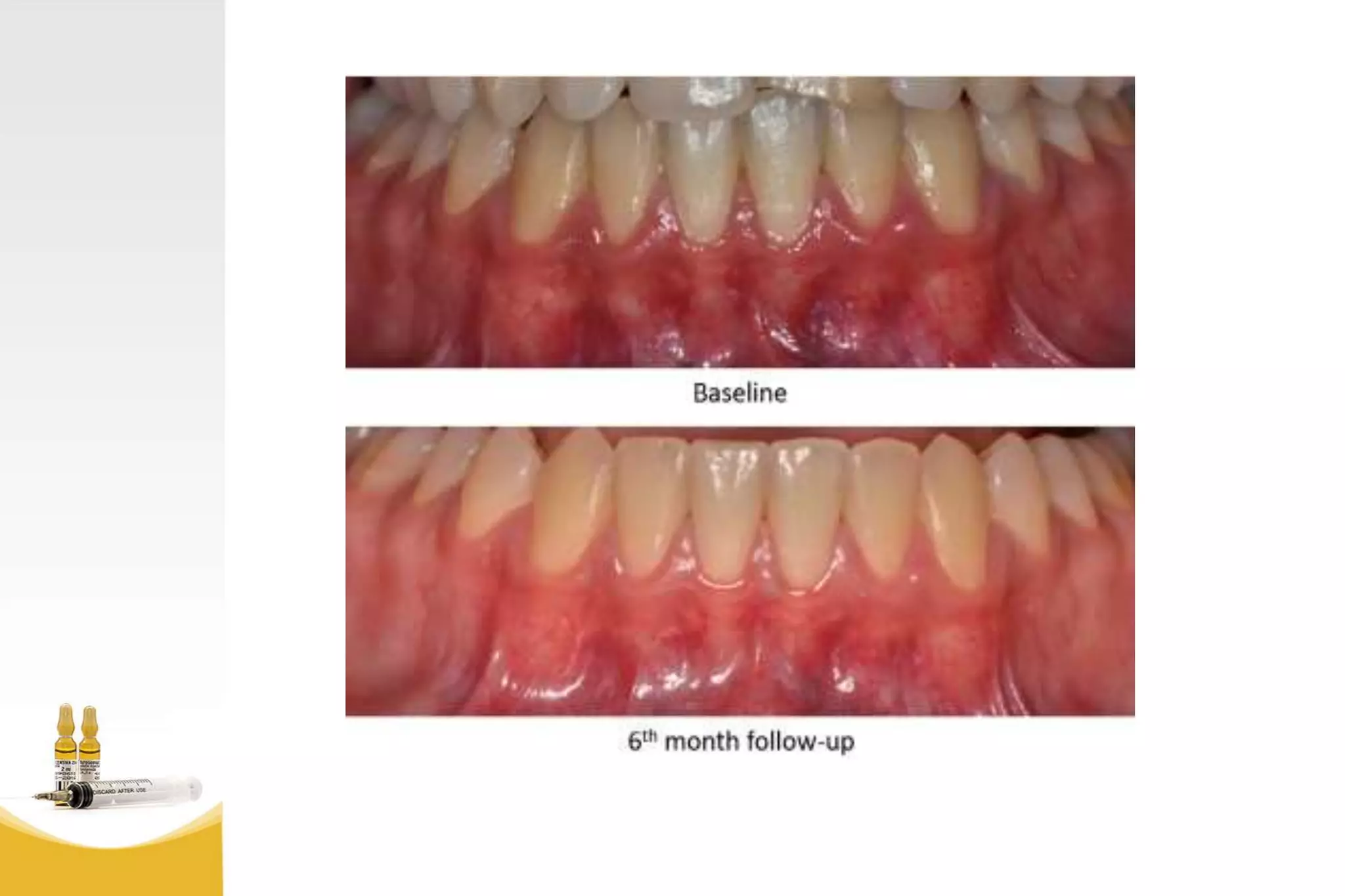 i-prf &MN in gingival augmentation in thin phenotype | PPTX
