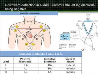 ECG Leads | PPTX