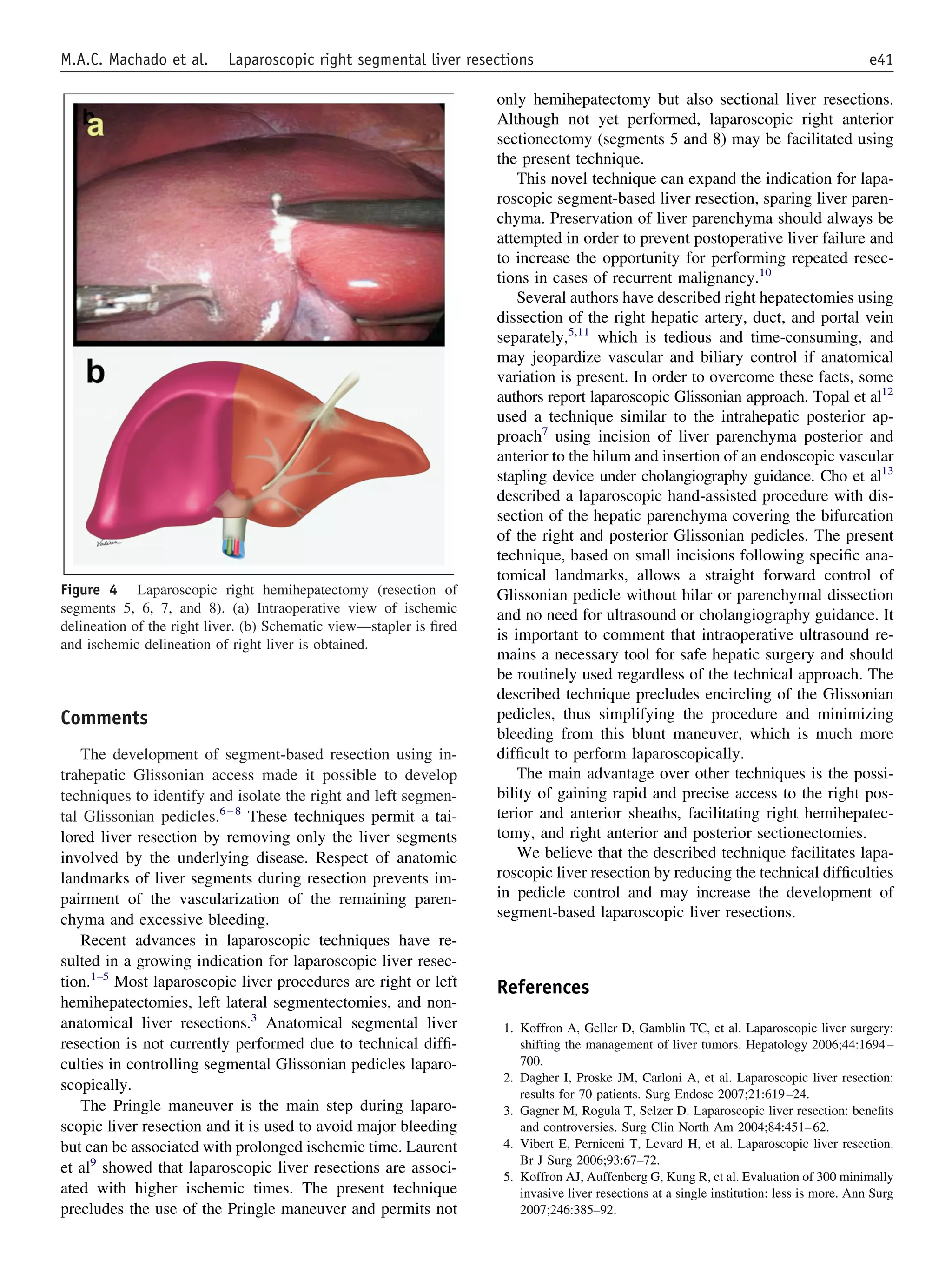 Glissonian approach for laparoscopic liver resections | PDF