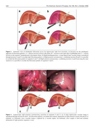 Glissonian approach for laparoscopic liver resections | PDF