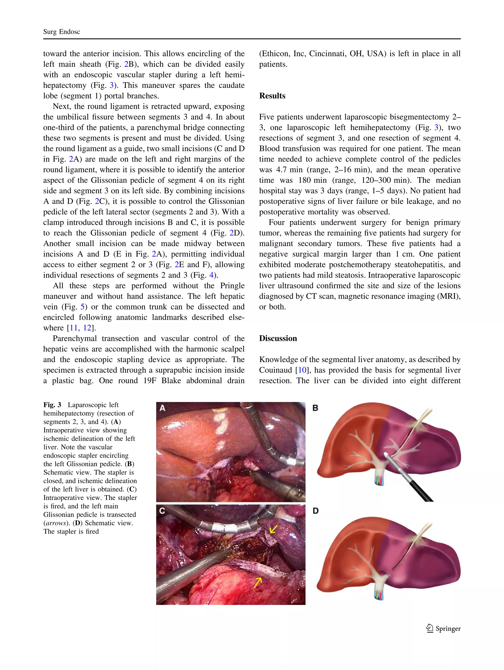 Laparoscopic intrahepatic Glissonian technique for liver surgery. Hepatectomia laparoscopica. | PDF