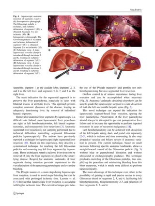 Laparoscopic intrahepatic Glissonian technique for liver surgery ...