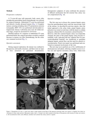 Appleby operation for pancreatic cancer. Cancer de pancreas ...