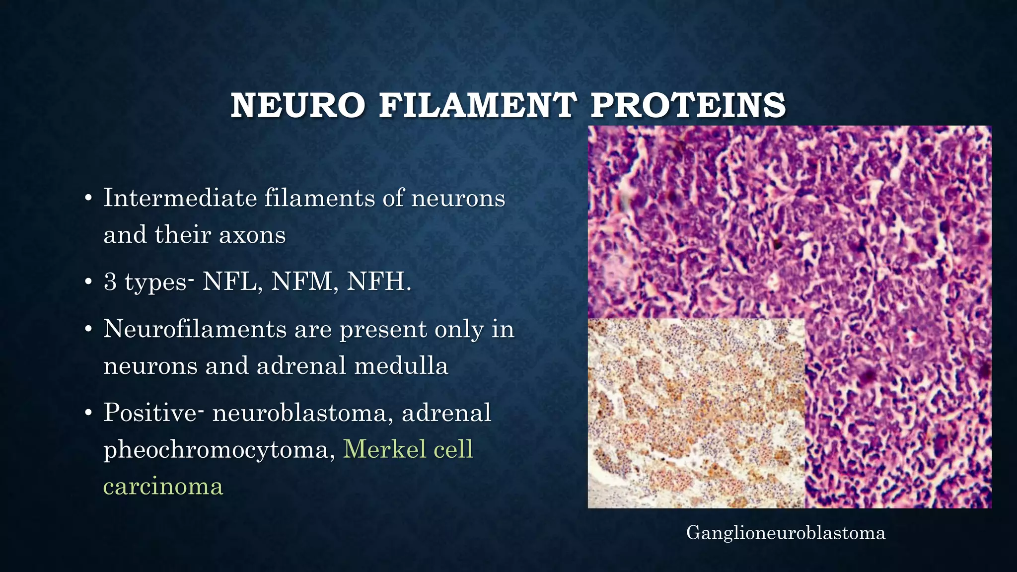 Immunohistochemistry in diagnosis of soft tissue tumours seminar | PPTX