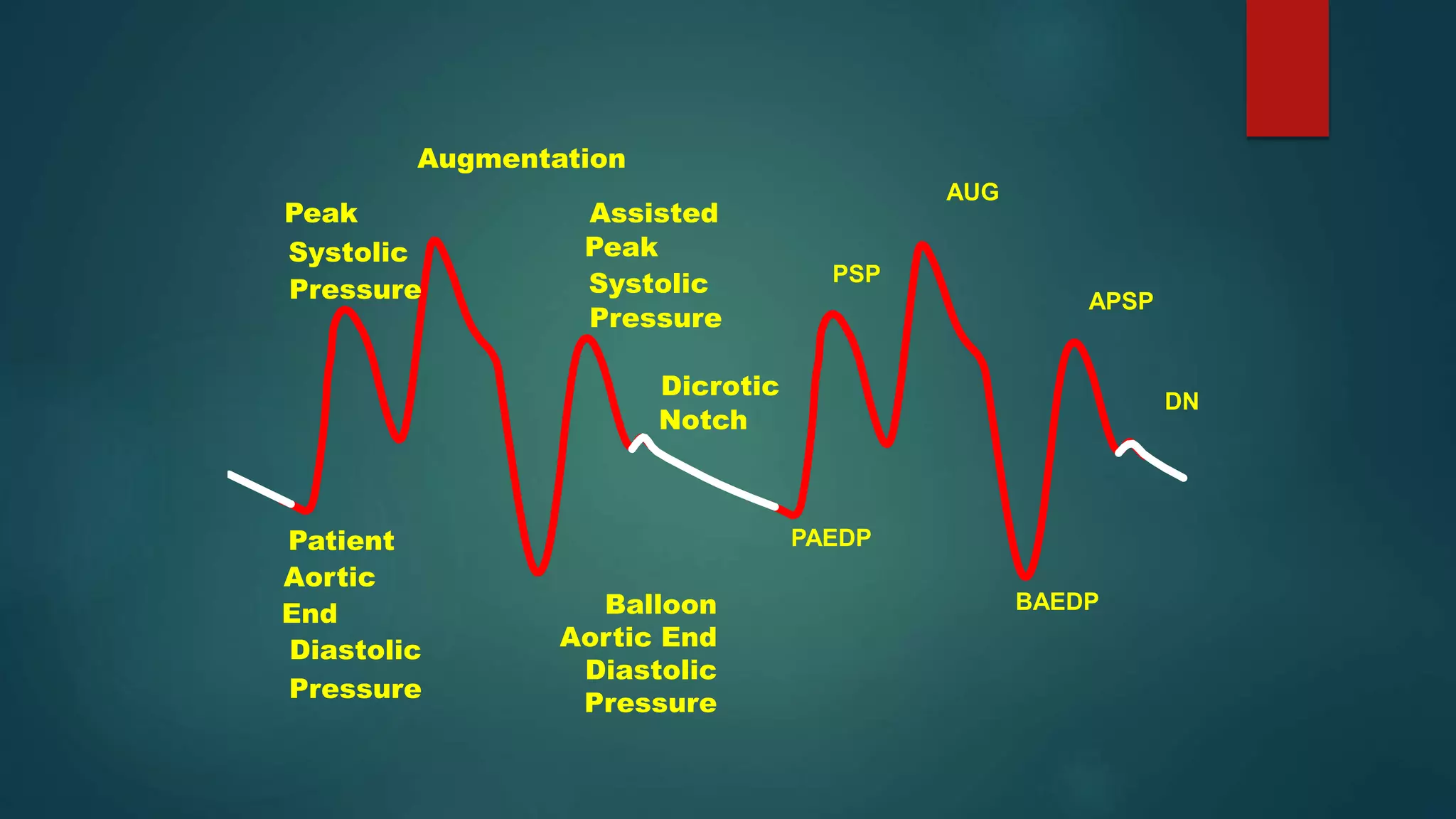 IABP when , why and how ? | PPTX