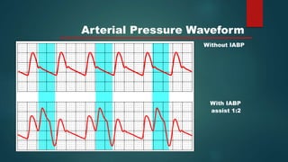 IABP when , why and how ? | PPTX